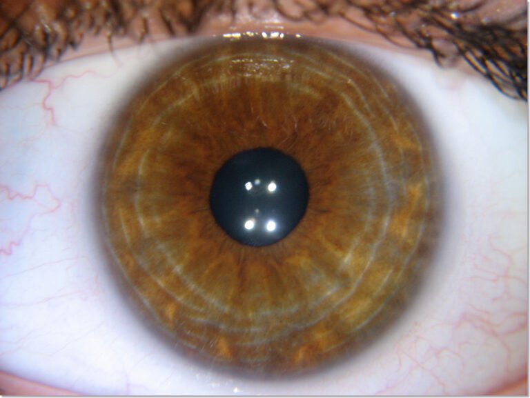Cholesterol Ring Iridology: What Your Iris Reveals | Eye Health
