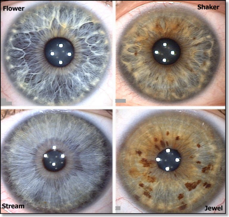 How To Read An Iridology Iris Chart Like A Professional