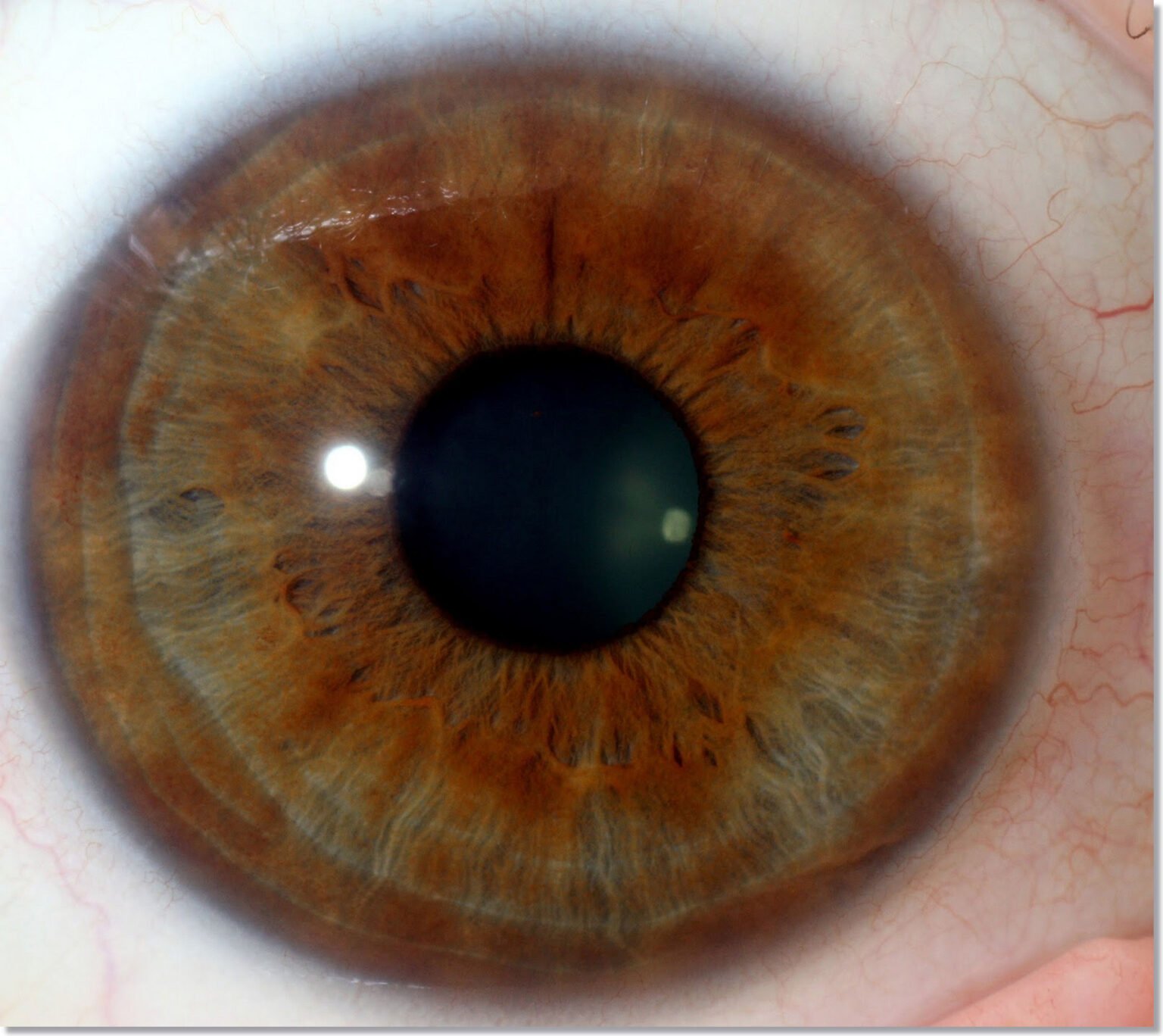 Hidden World Of Iris Patterns: Identity, Health & Security