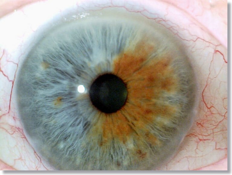 Medical Term Iris: The Colored Structure That Controls Light Entry Into ...